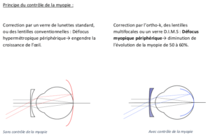 Contrôle de la myopie – Optique de la Combe